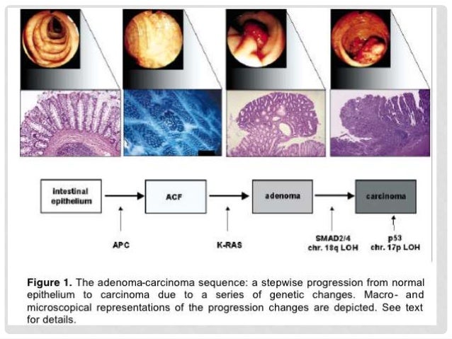 Adenoma carcinoma