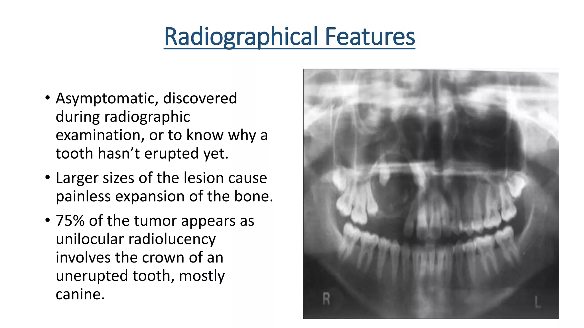 Adenomatoid odontogenic tumor | PPTX