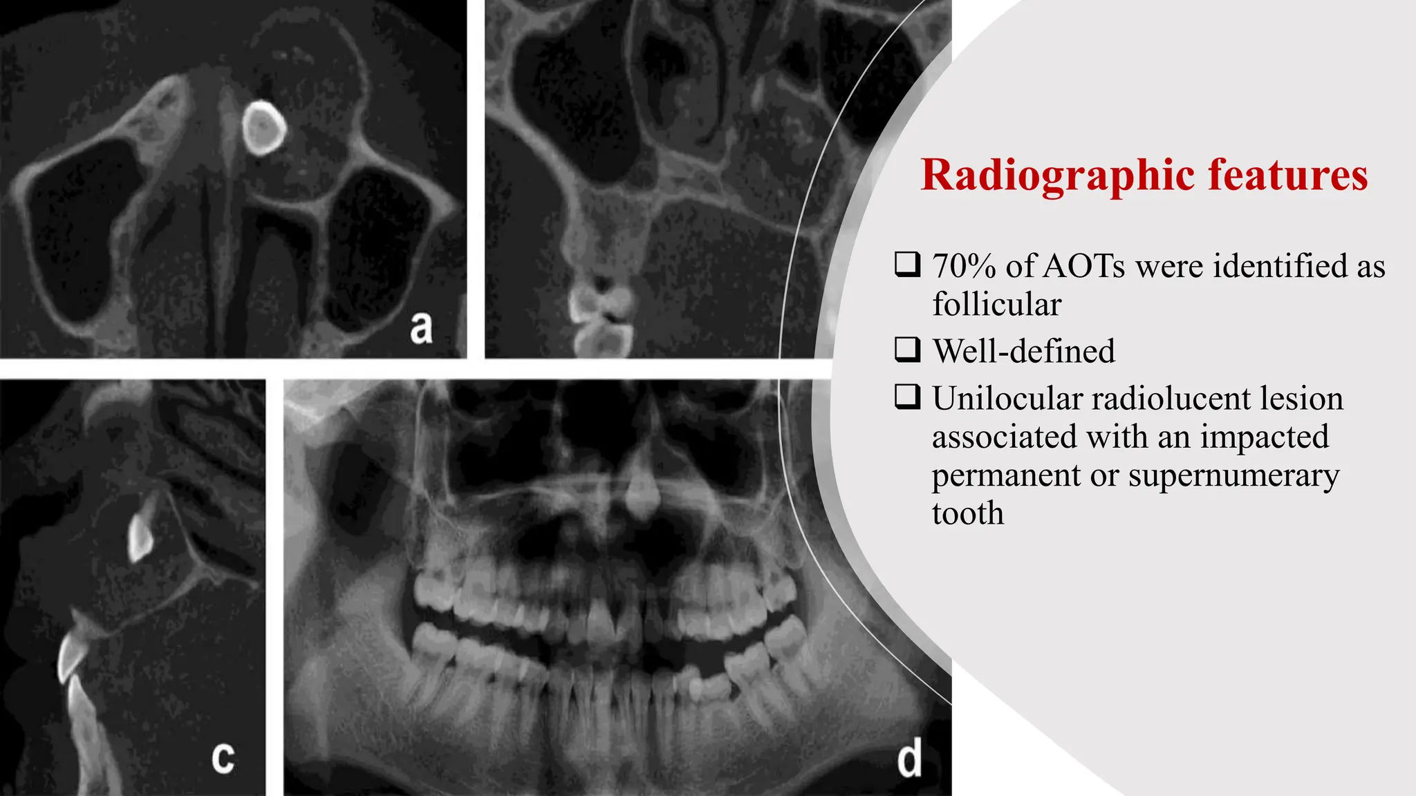 Adenomatoid odontogenic tumor, calcifying epithelial odontogenic tumors ...