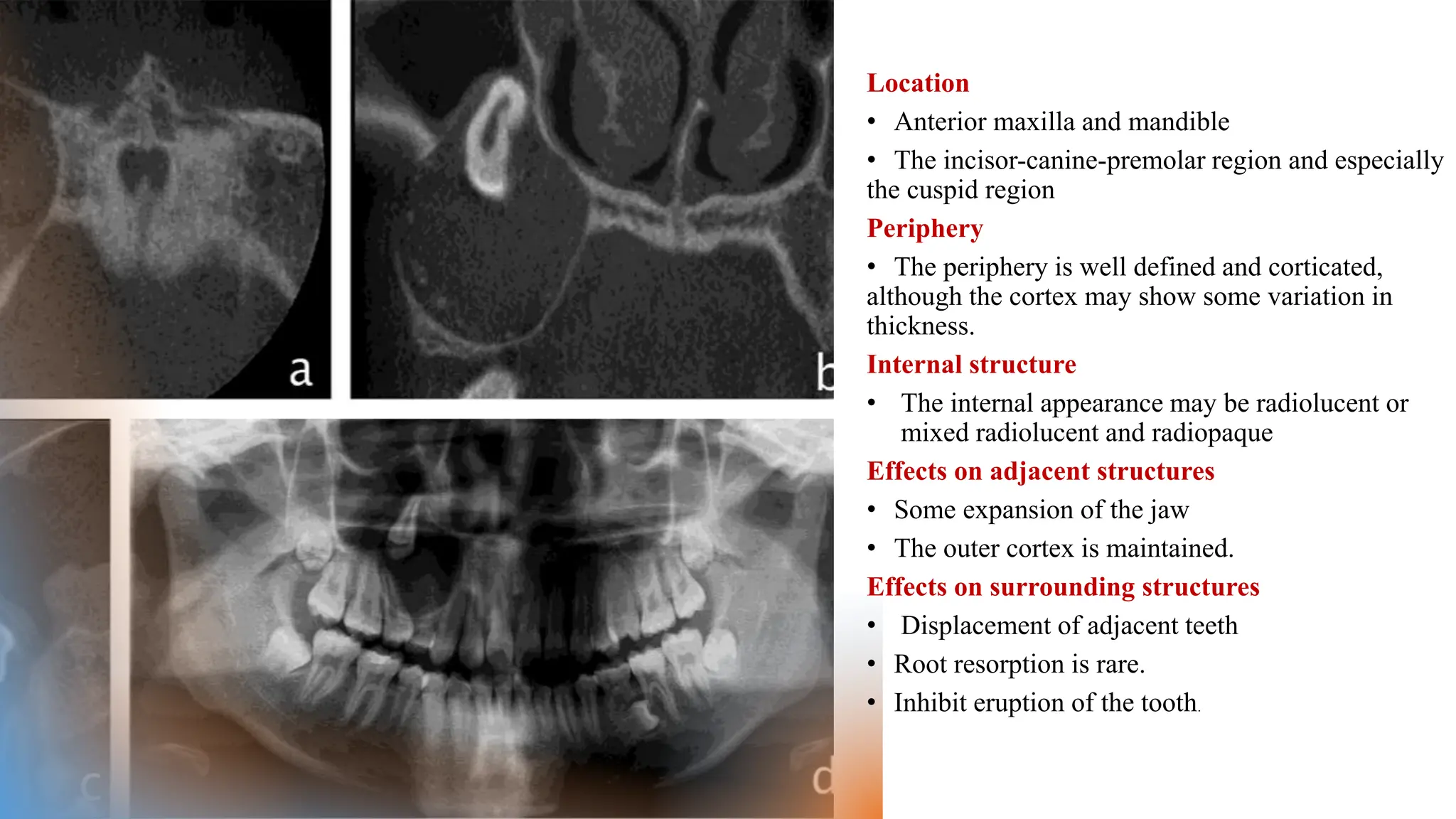 Adenomatoid odontogenic tumor, calcifying epithelial odontogenic tumors ...