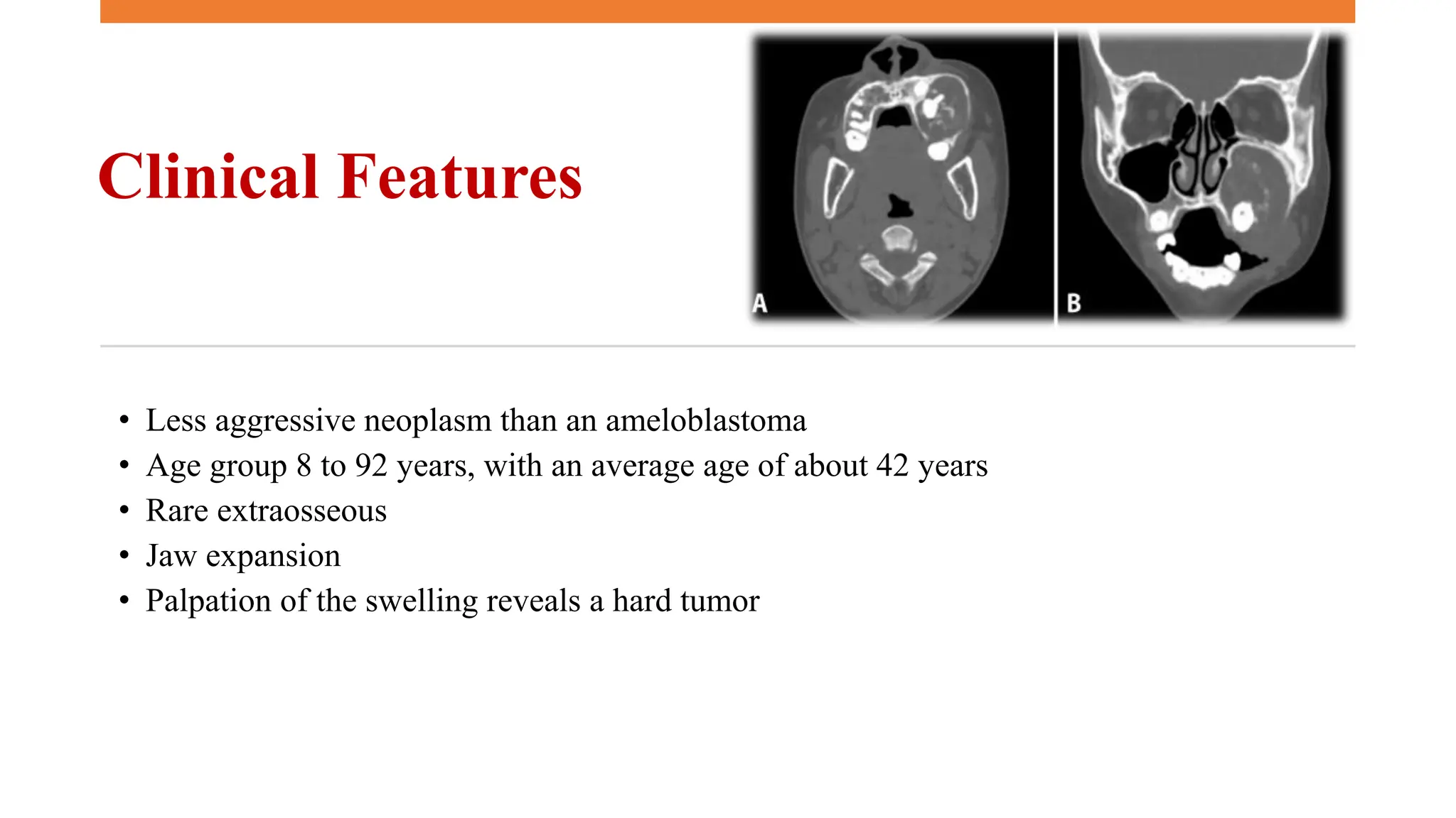 Adenomatoid odontogenic tumor, calcifying epithelial odontogenic tumors ...