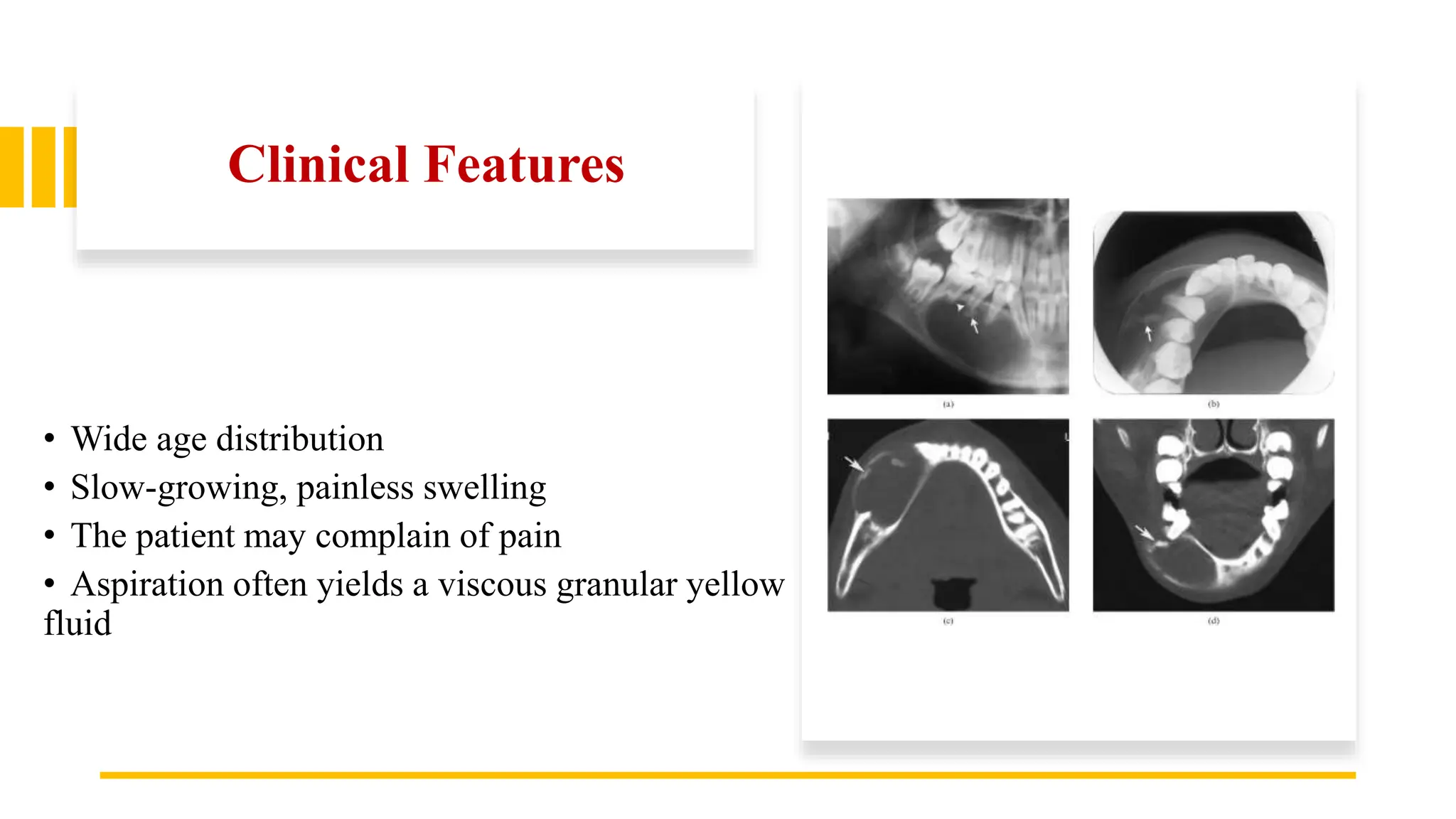 Adenomatoid odontogenic tumor, calcifying epithelial odontogenic tumors ...