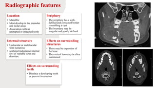 Adenomatoid odontogenic tumor, calcifying epithelial odontogenic tumors ...
