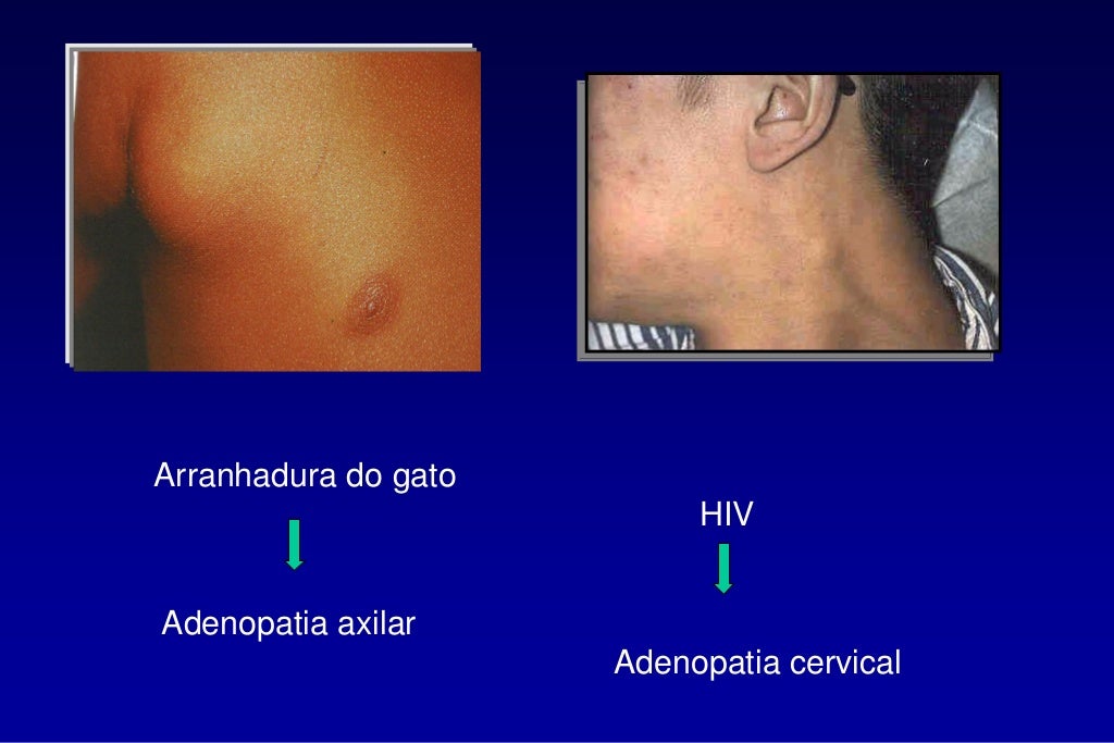 O Que é Adenomegalias - BRAINCP