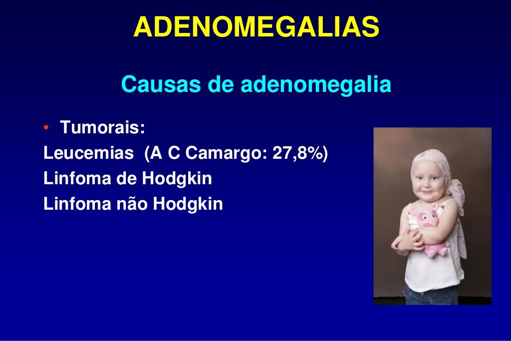 O Que é Adenomegalias - BRAINCP