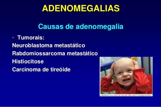 Adenomegalia