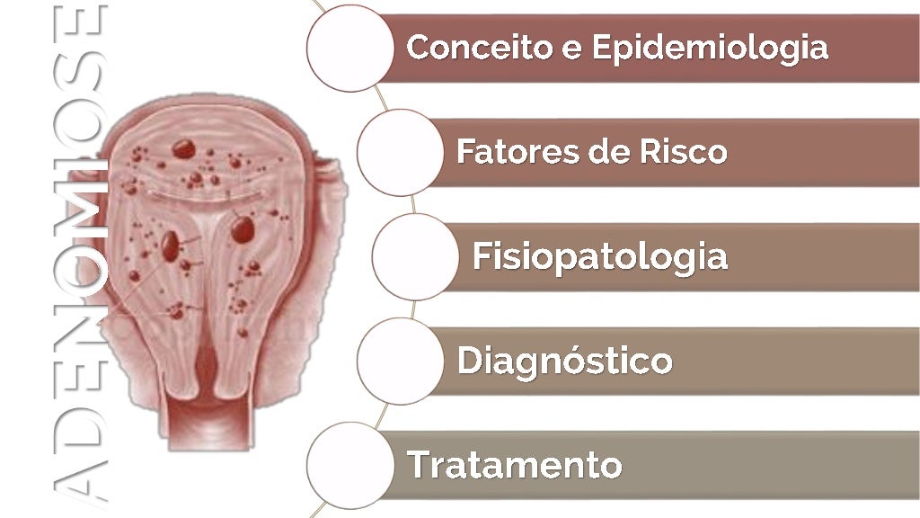Adenomiose / Adenomyosis: A Clinical Review of a Challenging Gynecolo…