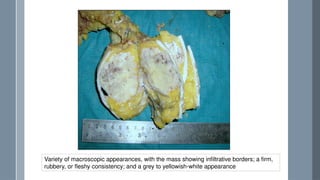 Adenomyoepithelioma Adenomyoepitheliomas | PPT