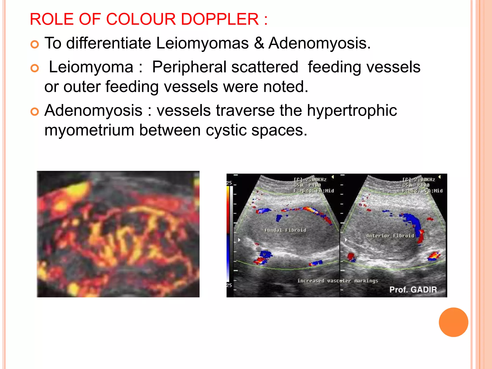 Adenomyosis | PPTX