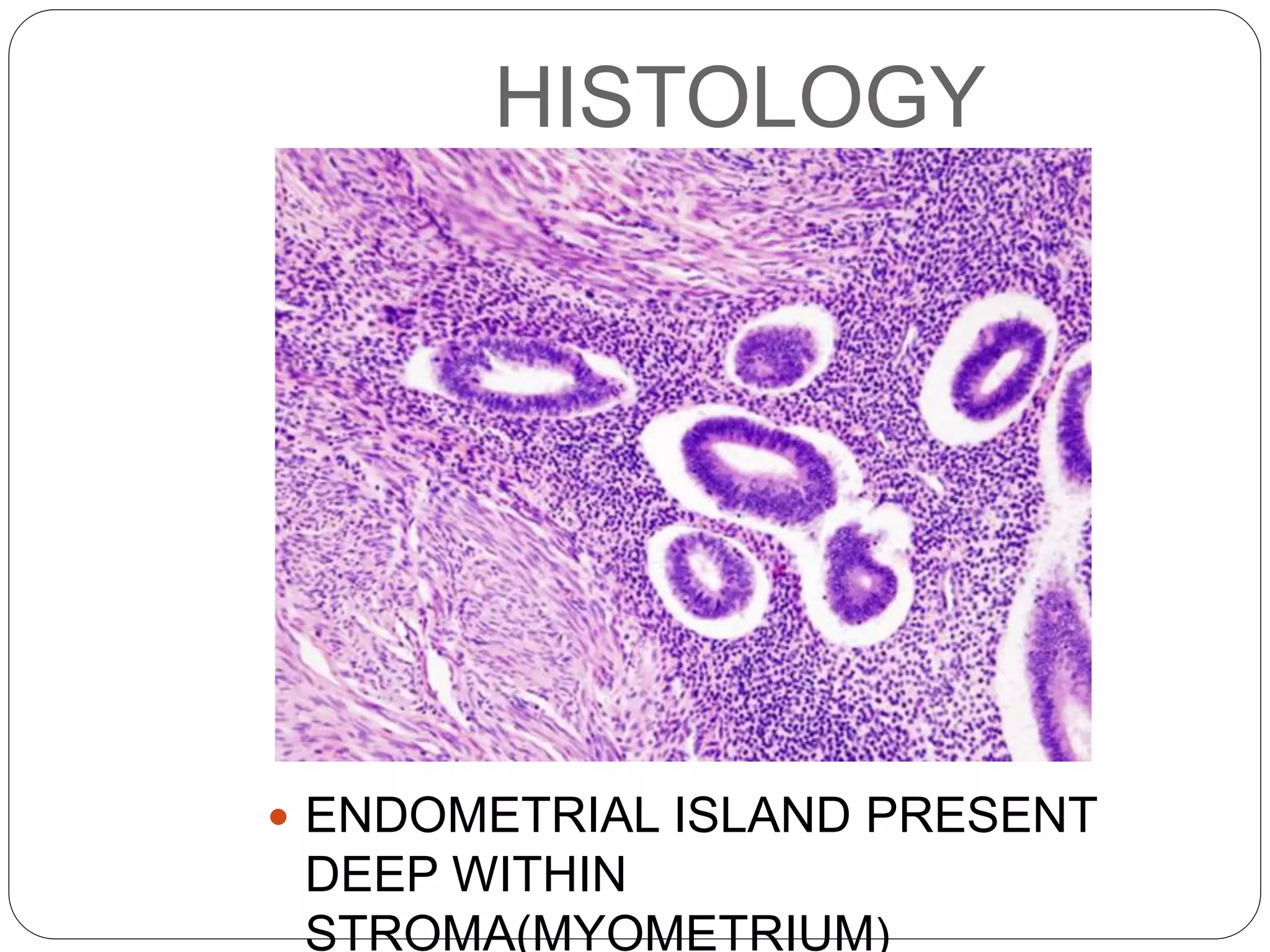 Adenomyosis | PPTX