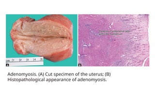 Adenomyosis .pptx adenomyosis adenomyosis and the uterus E-Placenta ...