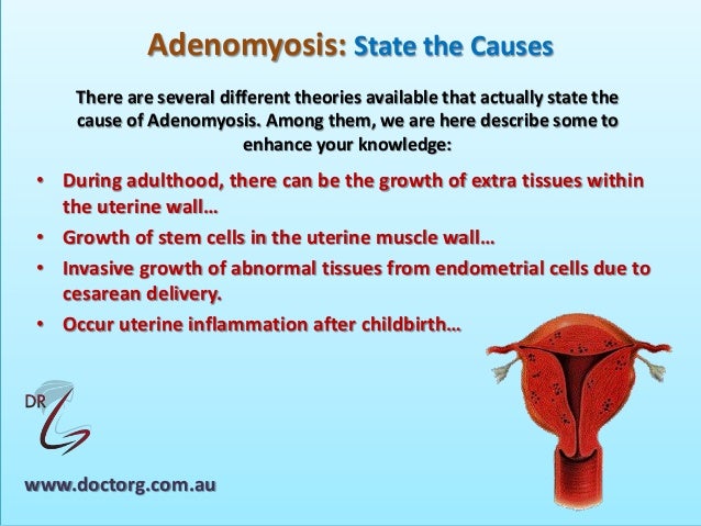 What Are Symptoms Of Adenomyosis