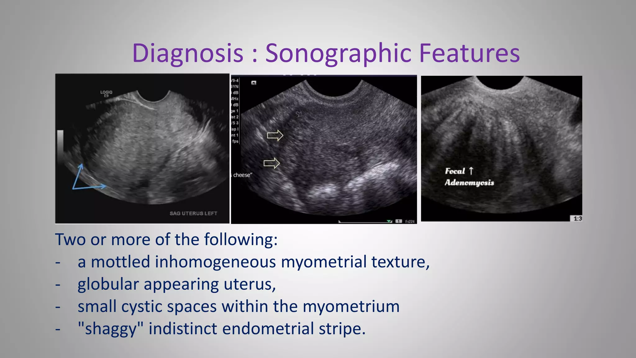 Adenomyosis & Infertility - A Webseries Talk | PPTX