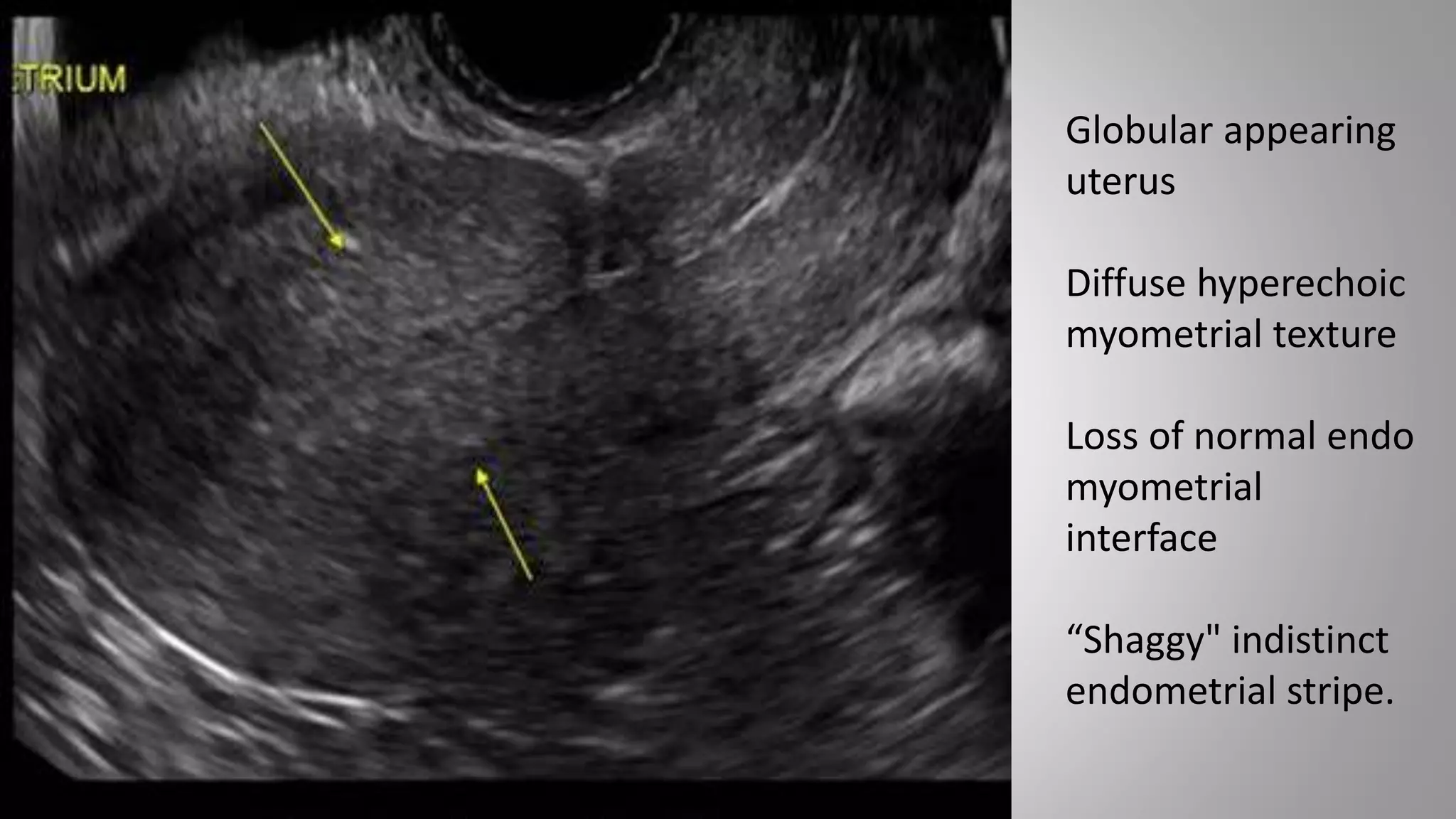 Adenomyosis & Infertility - A Webseries Talk | PPTX