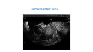 Diagnosing adenomyosis .pptx