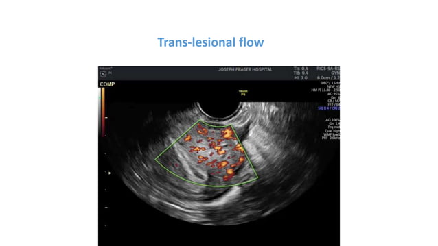 Diagnosing adenomyosis .pptx | Pregnancy | Reproductive Health