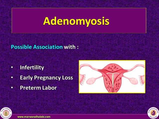 Adenomyosis and Assisted Conception | PDF