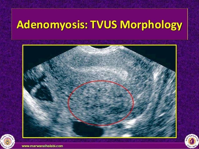 Adenomyosis and Assisted Conception