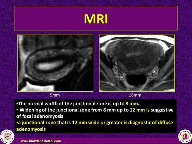 Adenomyosis and Assisted Conception