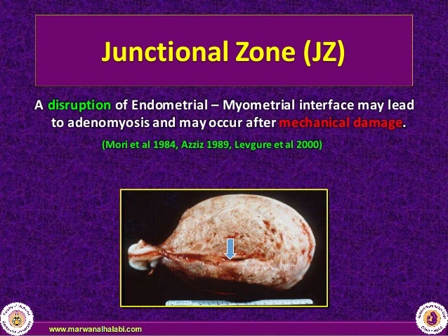 Adenomyosis and Assisted Conception