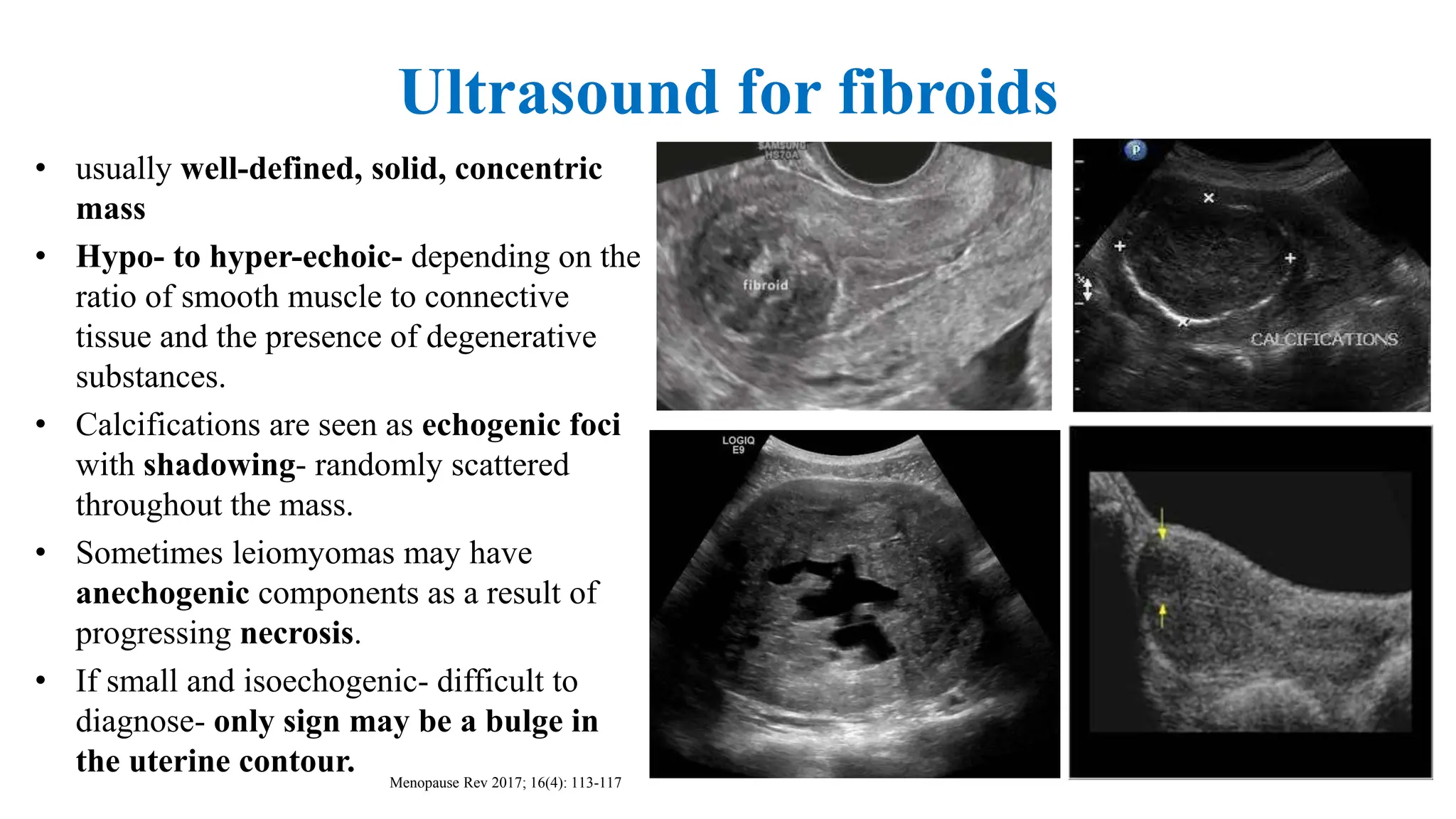 Adenomyosis or Fibroid- making right diagnosis | PPTX