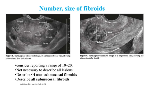 Adenomyosis or Fibroid- making right diagnosis | PPTX | Pregnancy ...