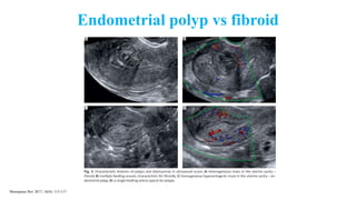 Adenomyosis or Fibroid- making right diagnosis | PPTX