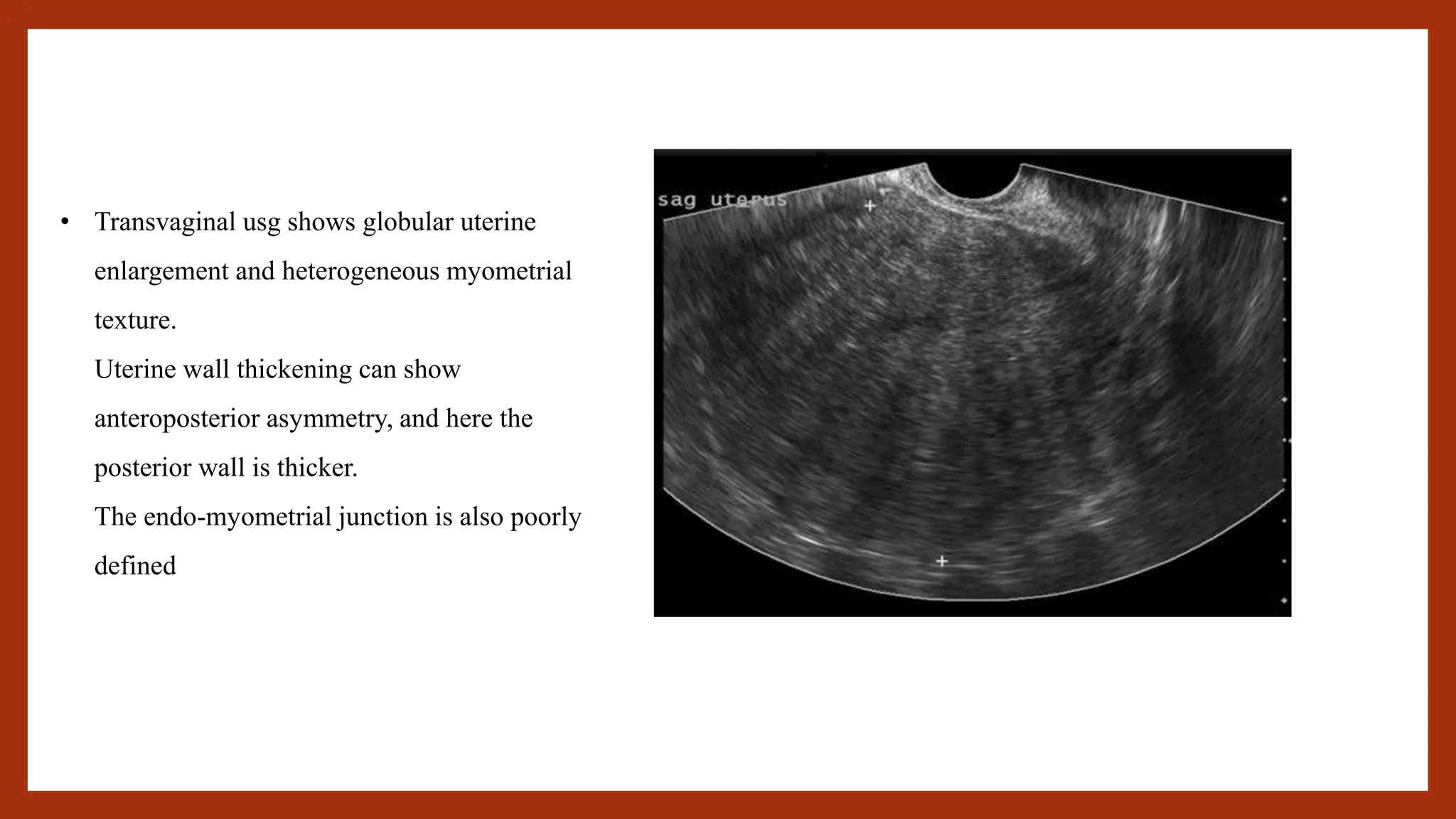 ADENOMYOSIS PPT 1.pptx
