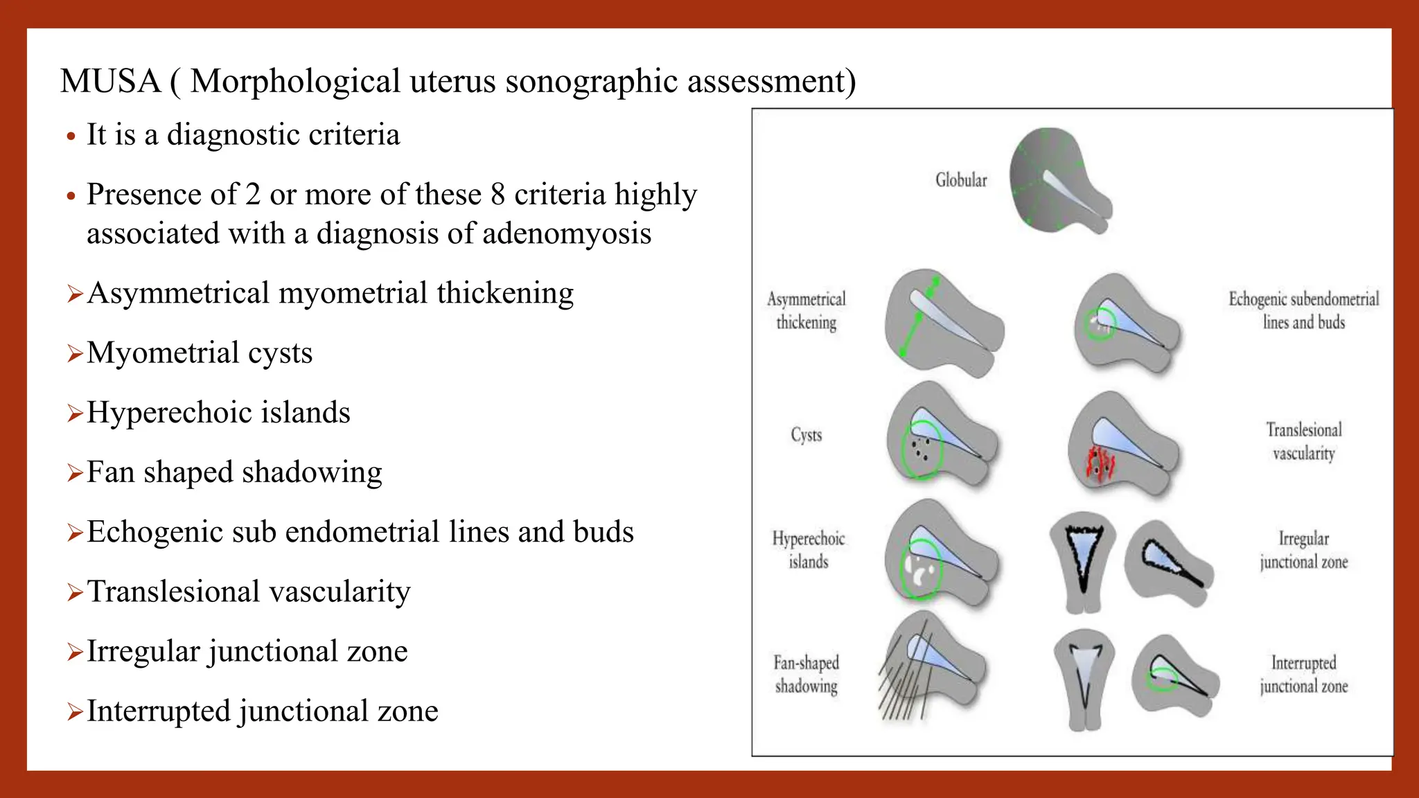 ADENOMYOSIS PPT 1.pptx