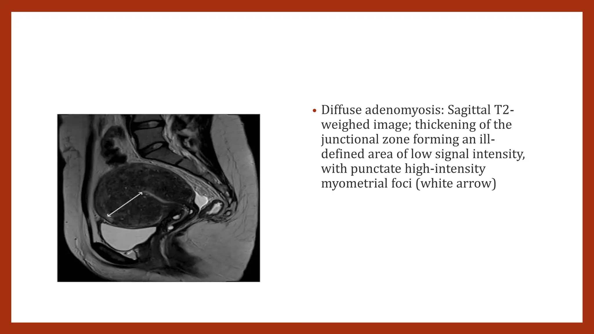 ADENOMYOSIS PPT 1.pptx