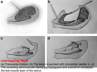 Uterine-Sparing Surgery for Adenomyosis Prof. Aboubakr Elnashar | PPSX