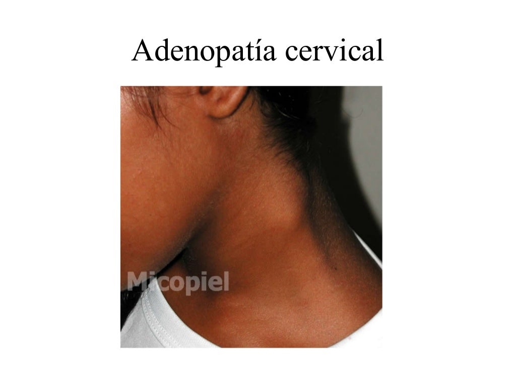 Adenopatías