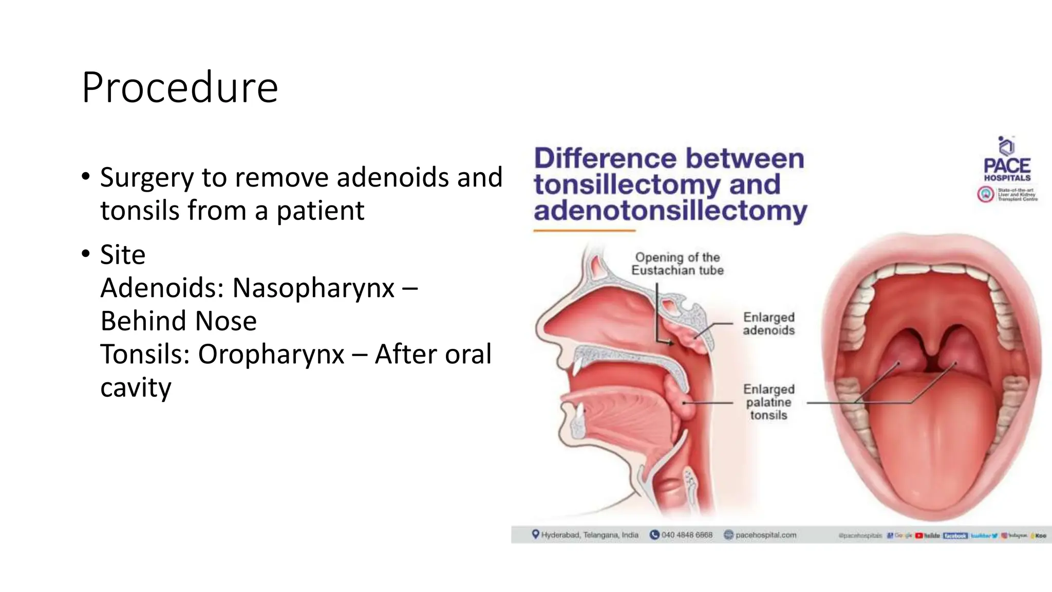 Adenotonsillectomy.pptx