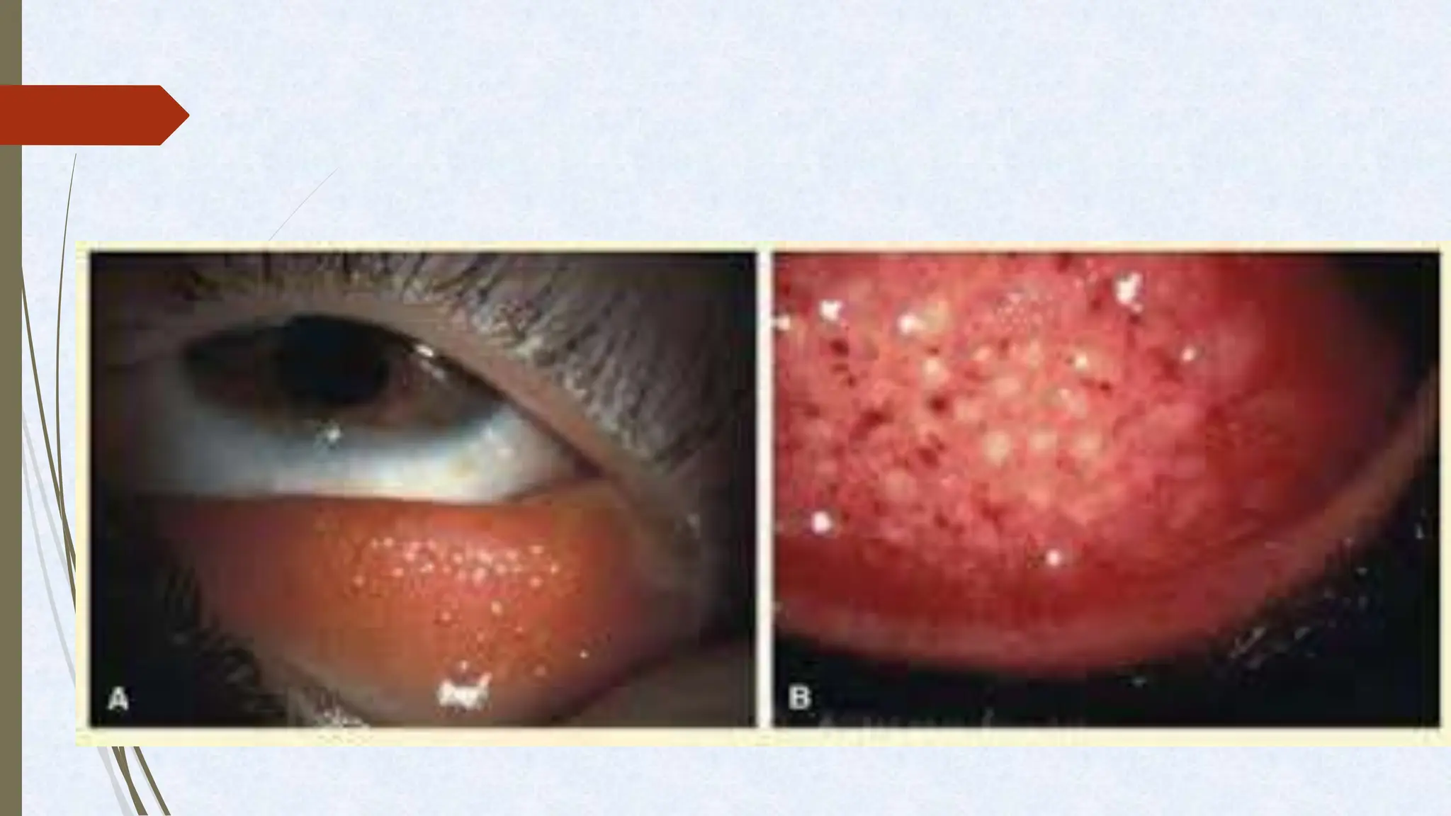 ADENOVIRAL-KERATOCONJUNCTIVITIS NIO&H Residency | PPTX