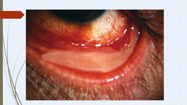 ADENOVIRAL-KERATOCONJUNCTIVITIS NIO&H Residency | PPTX | Eye and Vision ...