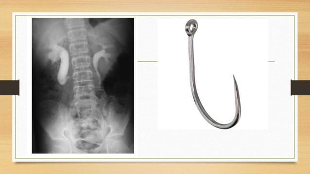 RETROCAVAL_URETER.pptx