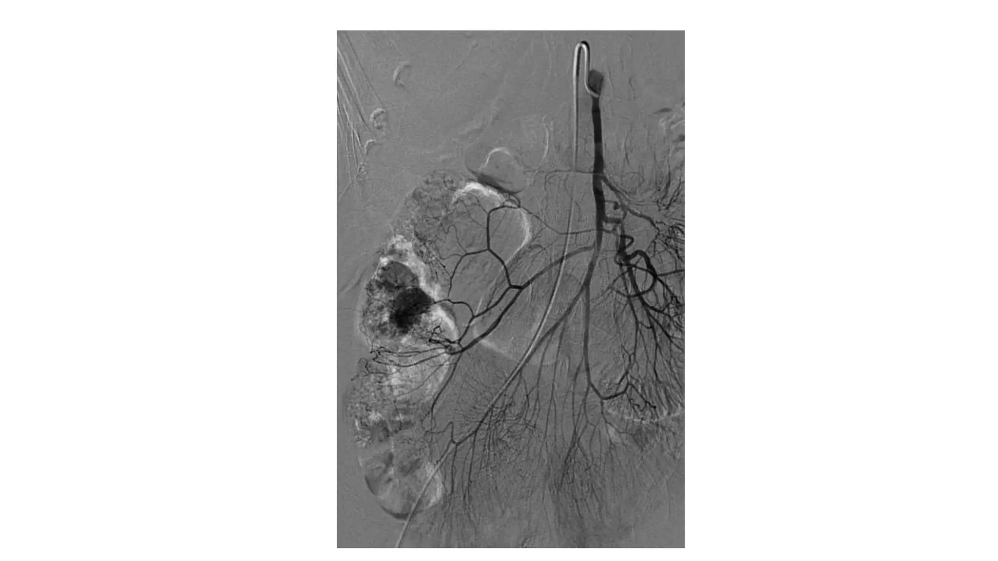 lower gastrointestinal bleeding ppt | PPTX