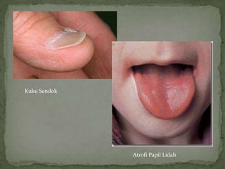 Anemia Defisiensi Besi | PPTX