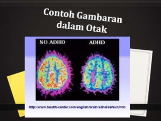 Adhd | PPTX