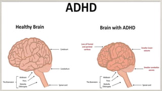 ADHD PRESEN.pptx