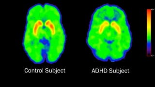 Adhd Slideshow Pptx