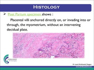 Placenta Accreta Histology