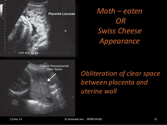 ADHERENT PLACENTA DIAGNOSIS & MANAGEMENT BY DR SHASHWAT JANI