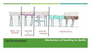 Dentine Bonding Agents Wikipedia, 58% OFF | pinnaxis.com