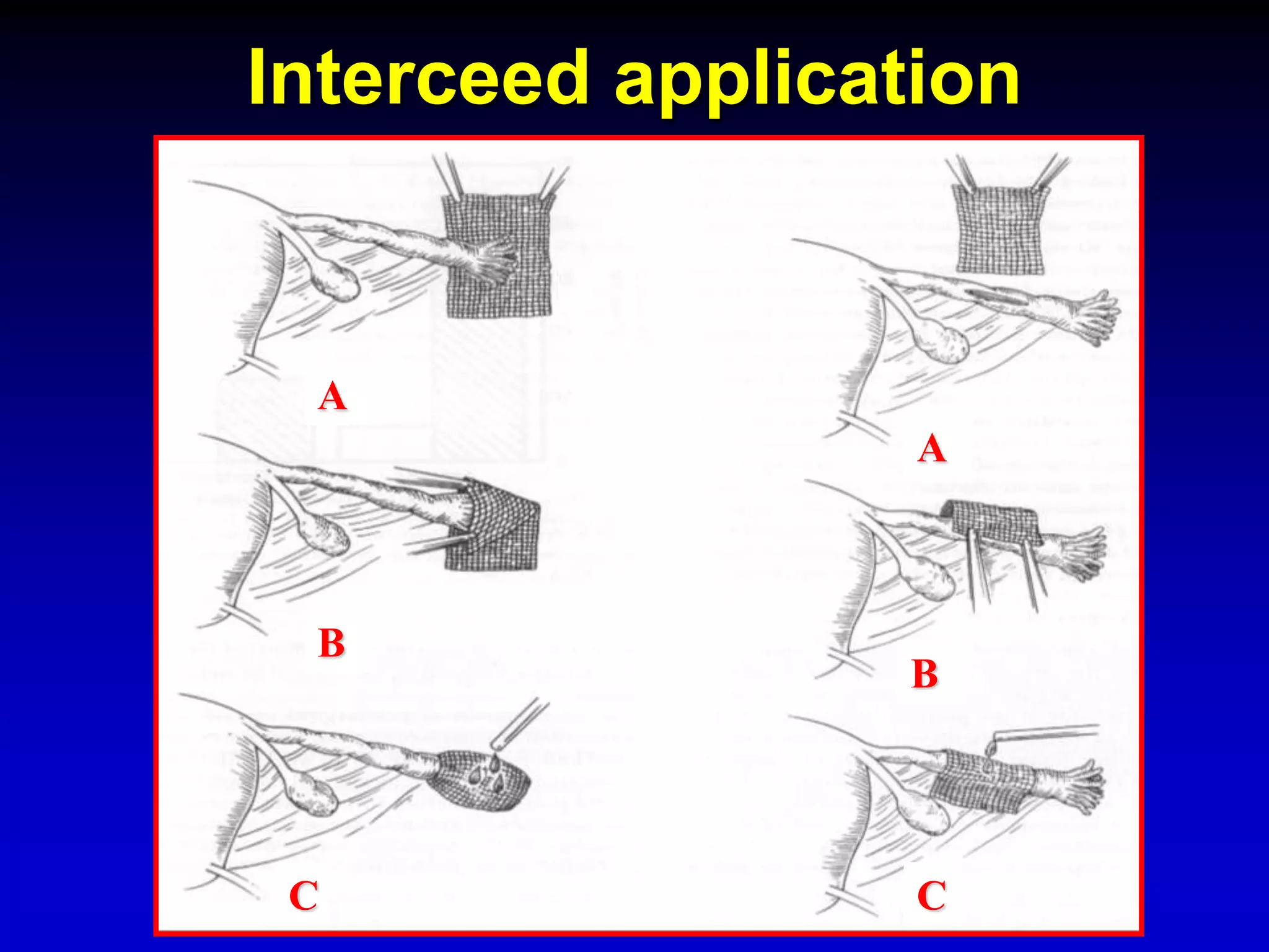 Adhesion prevention in peritoneal surgery | PPT
