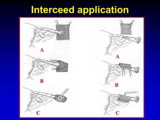 Adhesion prevention in peritoneal surgery | PPT