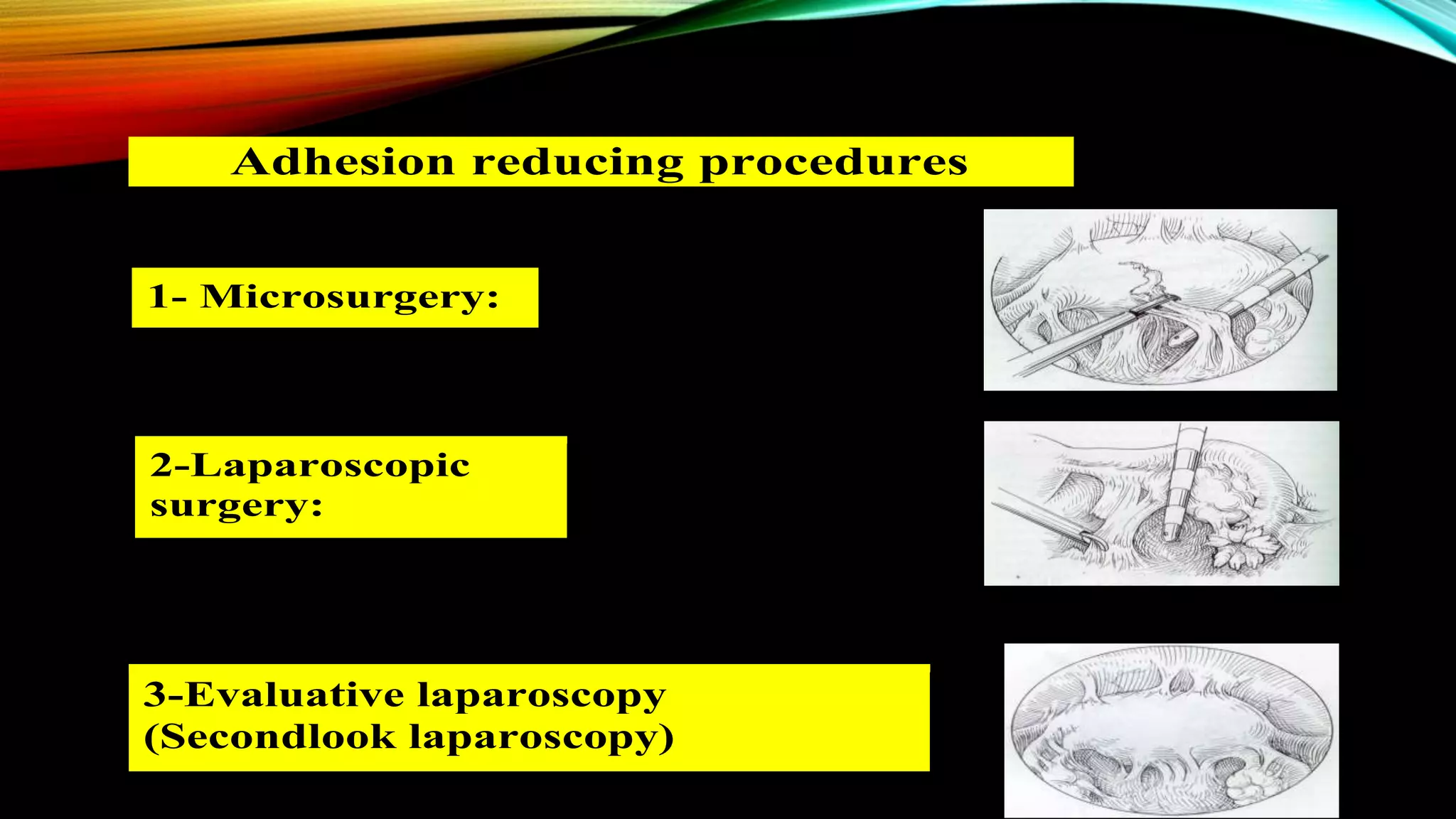 Adhesion prevention techniques | PPTX | Digestive Disorders | Diseases ...