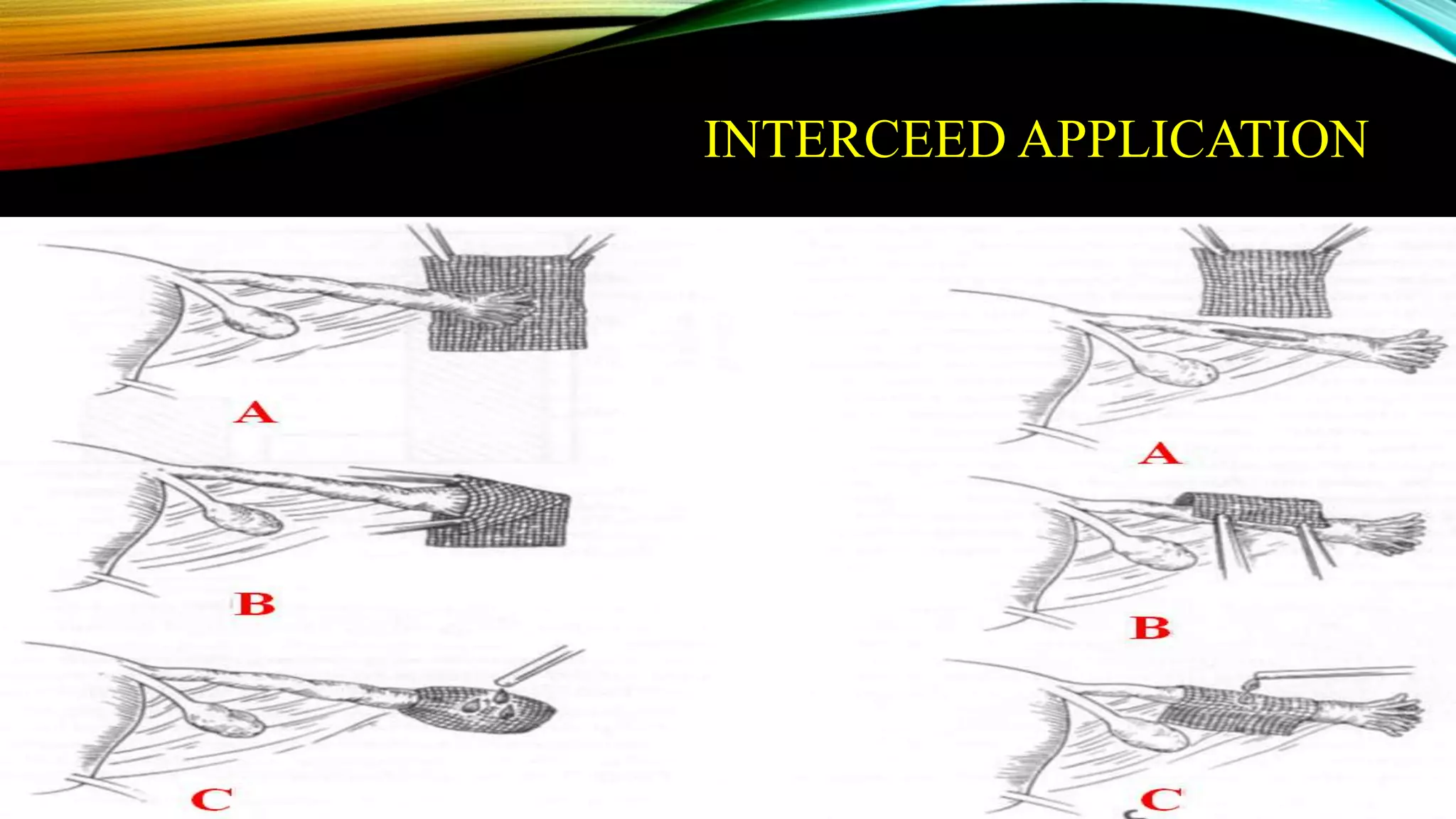 Adhesion prevention techniques | PPTX | Digestive Disorders | Diseases ...