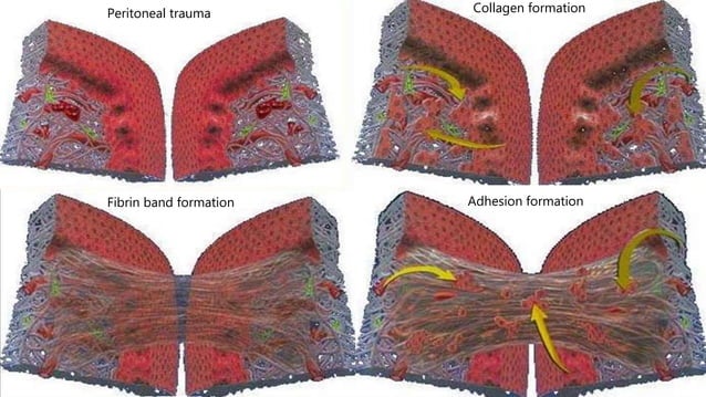 Adhesion prevention techniques | PPTX | Digestive Disorders | Diseases ...