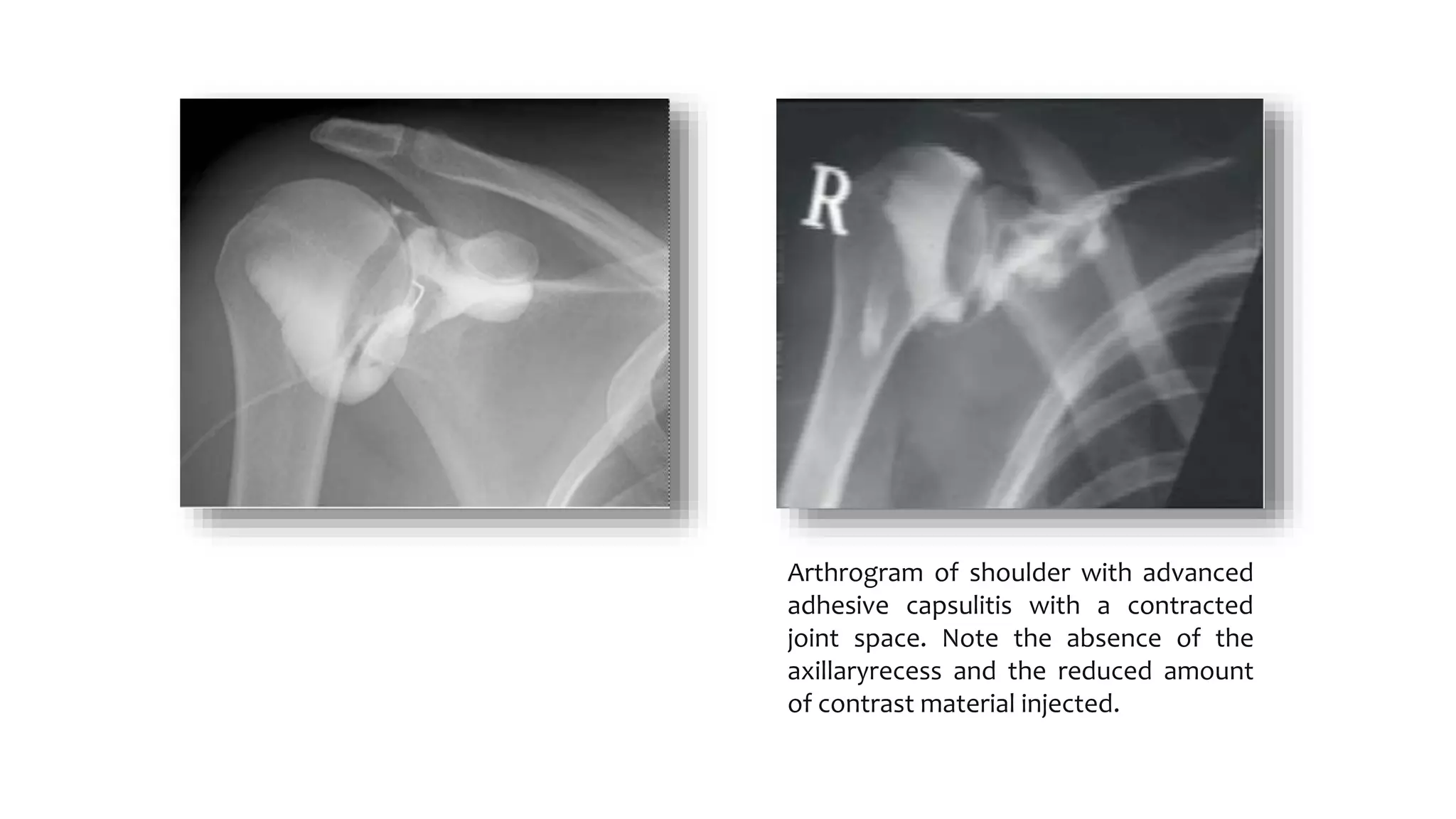 Adhesive capsulitis | PPTX